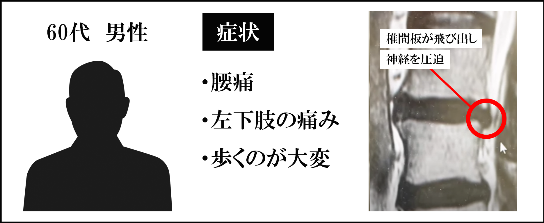 【症例：60代男性】椎間板ヘルニアをレーザーで焼いて除圧する日帰り腰痛治療「PLDD」とは？ | 表参道総合医療クリニック